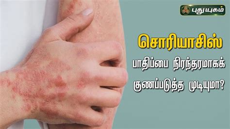 சொரியாசிஸ் இருந்தால் தவிர்க்க வேண்டிய உணவுகள் Dr Uma Maheswari விளக்கம் Doctoroncall Youtube