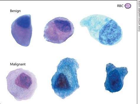 High Grade Urothelial Carcinoma On Urine Cytology Resembling Umbrella