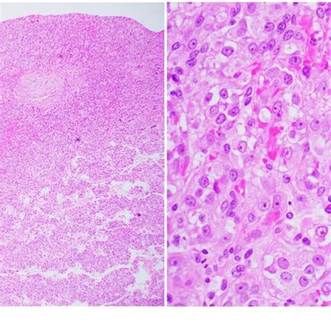 A Hypercellular Stroma With A Nested Tumor Pattern Separated By Download Scientific Diagram