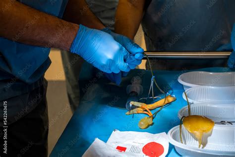 Penis Penile Implant Penis Enlargement Surgery Balloon Insertion