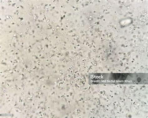 Pyospermia 또는 백혈구 세포정자를 보여주는 현미경 검사하에 정액 분석 정자 분석 정자에 대한 스톡 사진 및 기타 이미지 Istock