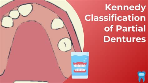 Kennedy Classification Of Removable Partial Dentures A Quick And Easy