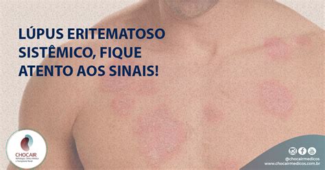 Lúpus Eritematoso Sistêmico Fique Atento Aos Sinais Chocair Médicos
