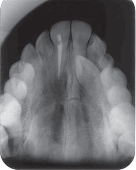 Dental Update The Talon Cusp An Uncommon Anomaly