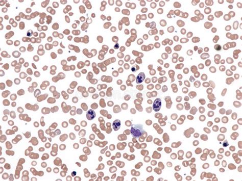 Eritroblastos En Sangre Periférica Foto de archivo Imagen de hueso irreverente