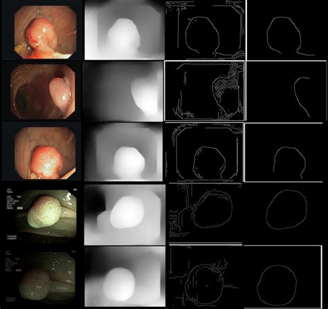polyp boundary detection using depth map column 1 original endoscopic download scientific