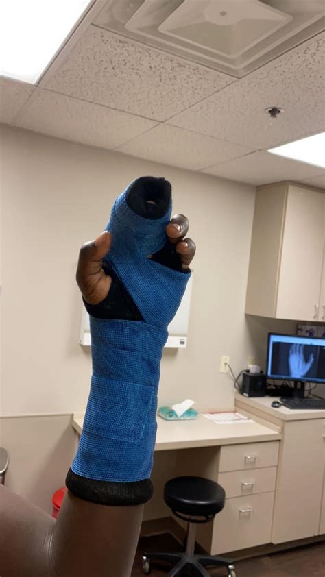 Boxers Fracture Of The 3rd Metacarpal R Radiology