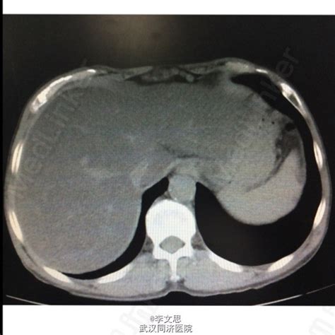 肝脏ct读片诊断 医联
