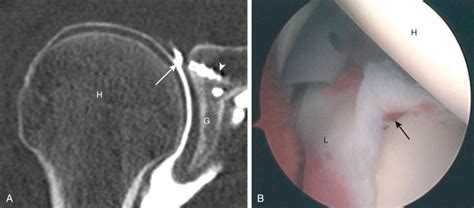 Failed Slap Tear Diagnosis And Management Clinical Tree
