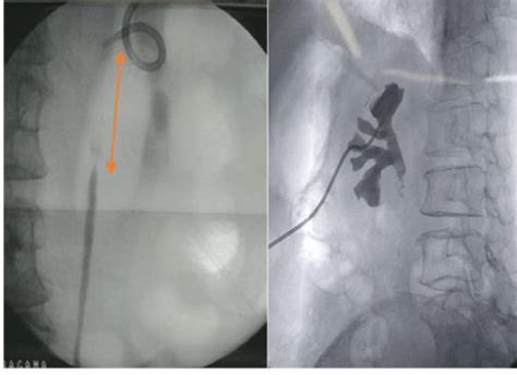 Retrograde And Antegrade Pyelogram Showing Long Left Upper Ureteric