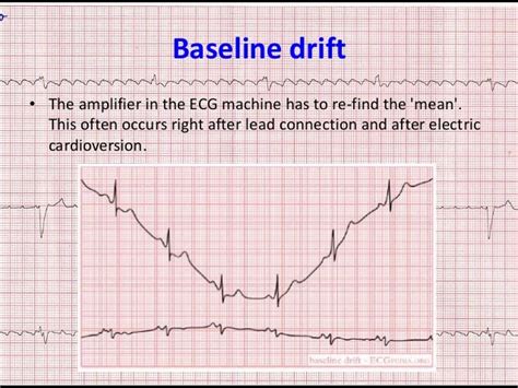 Ecg Artifacts And Pitfalls