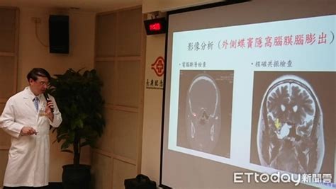 腦脊液滲漏當「流鼻水」 細菌「上竄」恐致奪命腦膜炎 Ettoday健康雲 Ettoday新聞雲