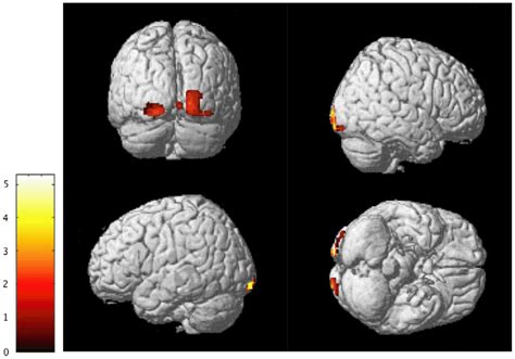 voxel based morphometry results significant differences between