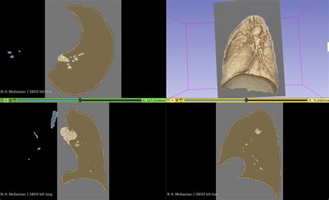 Volume Rendering Lung Vessels Segmentation Without Contrast Support 3d Slicer Community