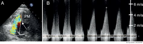 Vibration And Staccato Flow Pattern In Ventricular Assist Devices
