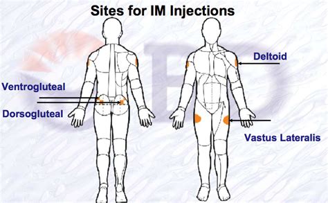 Sites For Intramuscular Im Injection Nursing Schools In Texas Nursing School Info Lpn Schools