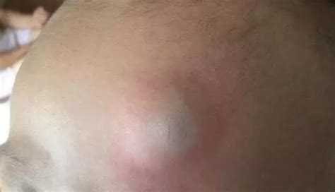 孩子头上磕个包不哭不闹照样玩哪知次日突然身亡 知乎
