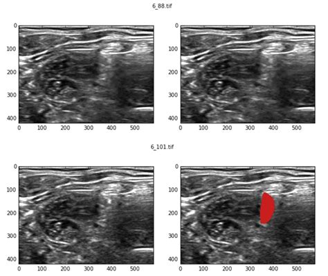 Ultrasound Nerve Segmentation Challenge On Kaggle