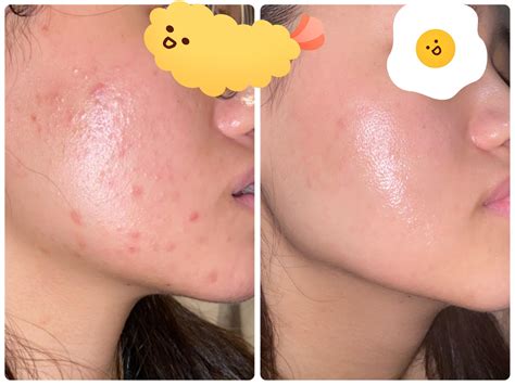 Before After Doxycycline Snail Mucin R Acne