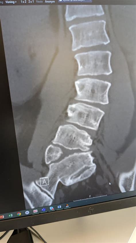 Heres Mine Surgery Required Daily Pain Rscoliosis