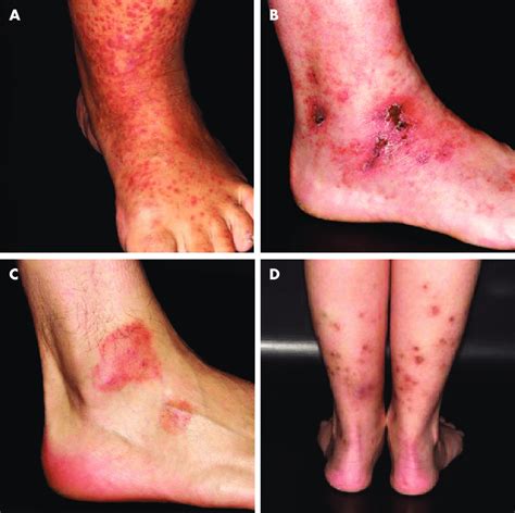 Vasculitis Cks