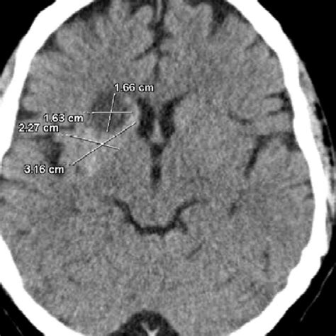 Ct Head Showing Hyperdensity Probable Hemorrhage In The Right Caudate