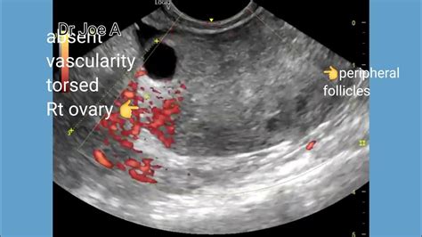 Torsion Ovary Sonography Ultrasound And Color Doppler Video Youtube
