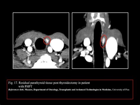 Figure 1 From Imaging Findings Of Parathyroid Lesions In Primary Hyperparathyroidism Semantic