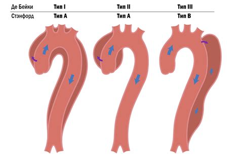 Расслаивающая аневризма аорты