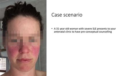 Obstetric Management Of SLE And APLS PPTX Pregnancy Reproductive Health