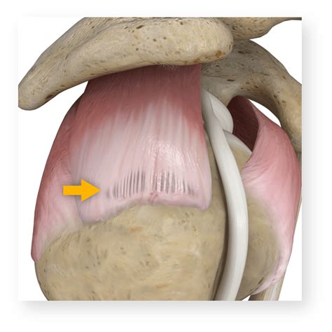 Rotator Cuff Tear In Polish At Jorja Helms Blog