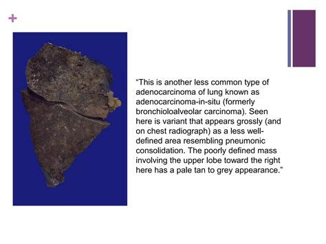 Lung Cancer Pathology And Clinical Pptx