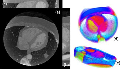 Image Volume Reconstructed From A Truncated Data Set By The Os Sart