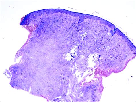 Histopathology Showing Diffuse Dense Infiltrate Involving Reticular Download Scientific