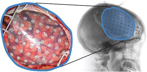 Figure 1 From Decoding Covert Spatial Attention Using Electrocorticographic Ecog Signals In