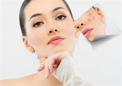 Homemade Face Packs To Remove Pimple Marks And Acne Scars