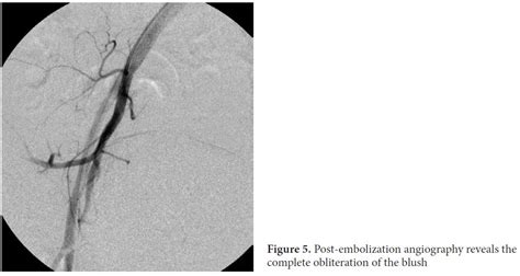 Transcatheter Artery Embolization For Postoperative Haemorrhage After