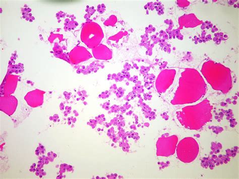 Micropapillary Adenocarcinoma Cell Block Of Pleural Fluid Case 240 A Photo On Flickriver
