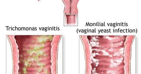 Relief For Vaginal Irritation Itching And Swelling Ehow Uk