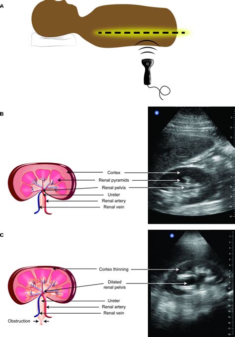 Pocus For Visualization And Facilitation Of Urinary Catheter Placement