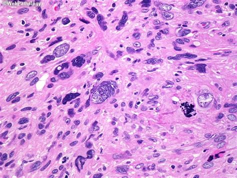 Pleomorphic Leiomyosarcoma