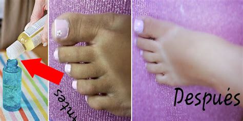 How To Remove Black Spots Of The Skin Within A Few Minutes