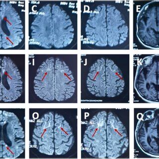Brain MRI Findings In The 39 Year Old Patient Diffusion Weighted Download Scientific Diagram