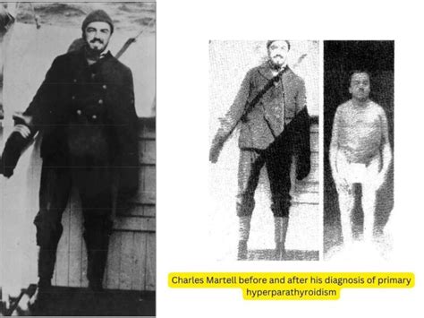 Primary Hyperparathyroidism A Comprehensive Guide For Patients My Endo Consult