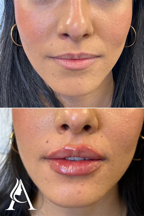 Lip Injection Before After Gallery Artofit