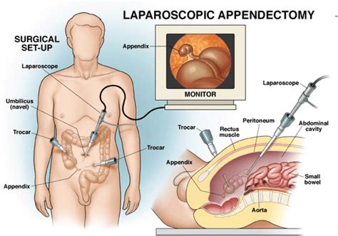 Appendix Surgery Cost In India Best General Laparoscopic Surgeon