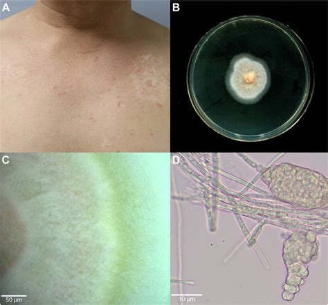 Case 2 A Erythematous Papules And Pustules On The Upper Chest And