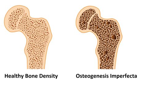 Osteogenesis Imperfecta Types