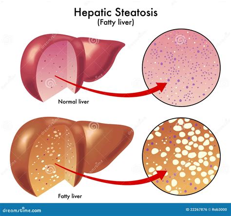 Hepatic Cartoons Illustrations And Vector Stock Images 8887 Pictures To Download From