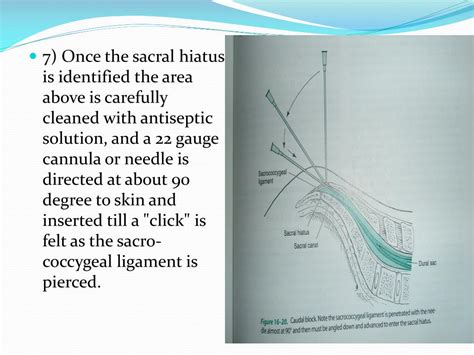 Ppt Caudal Anesthesia Powerpoint Presentation Free Download Id 755679